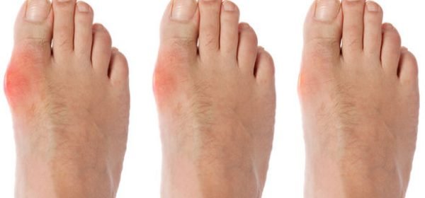 Truth About Gout - Gout Symptoms And Treatments